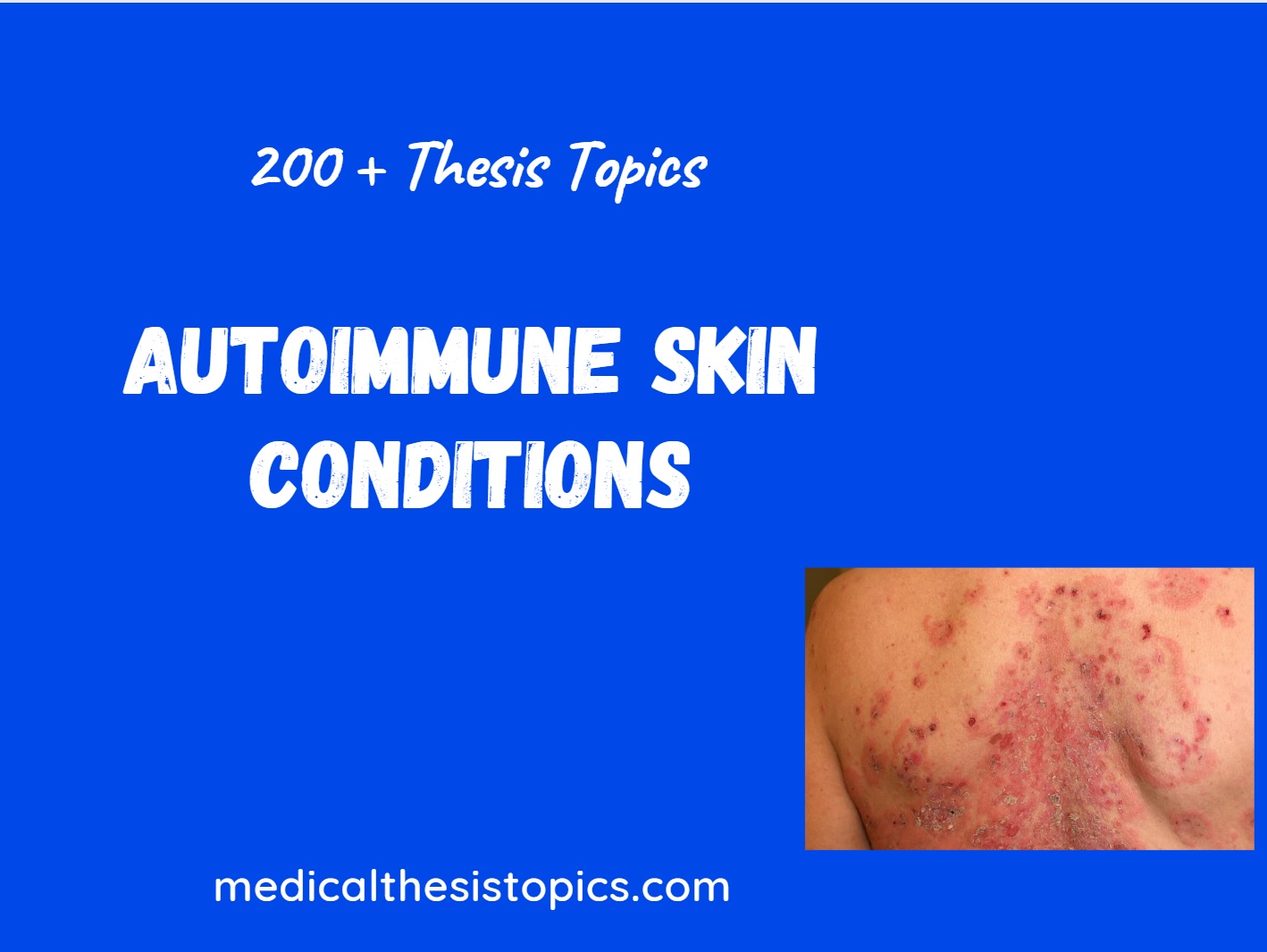 Dermatology Premium Thesis Topics on autoimmune skin conditions